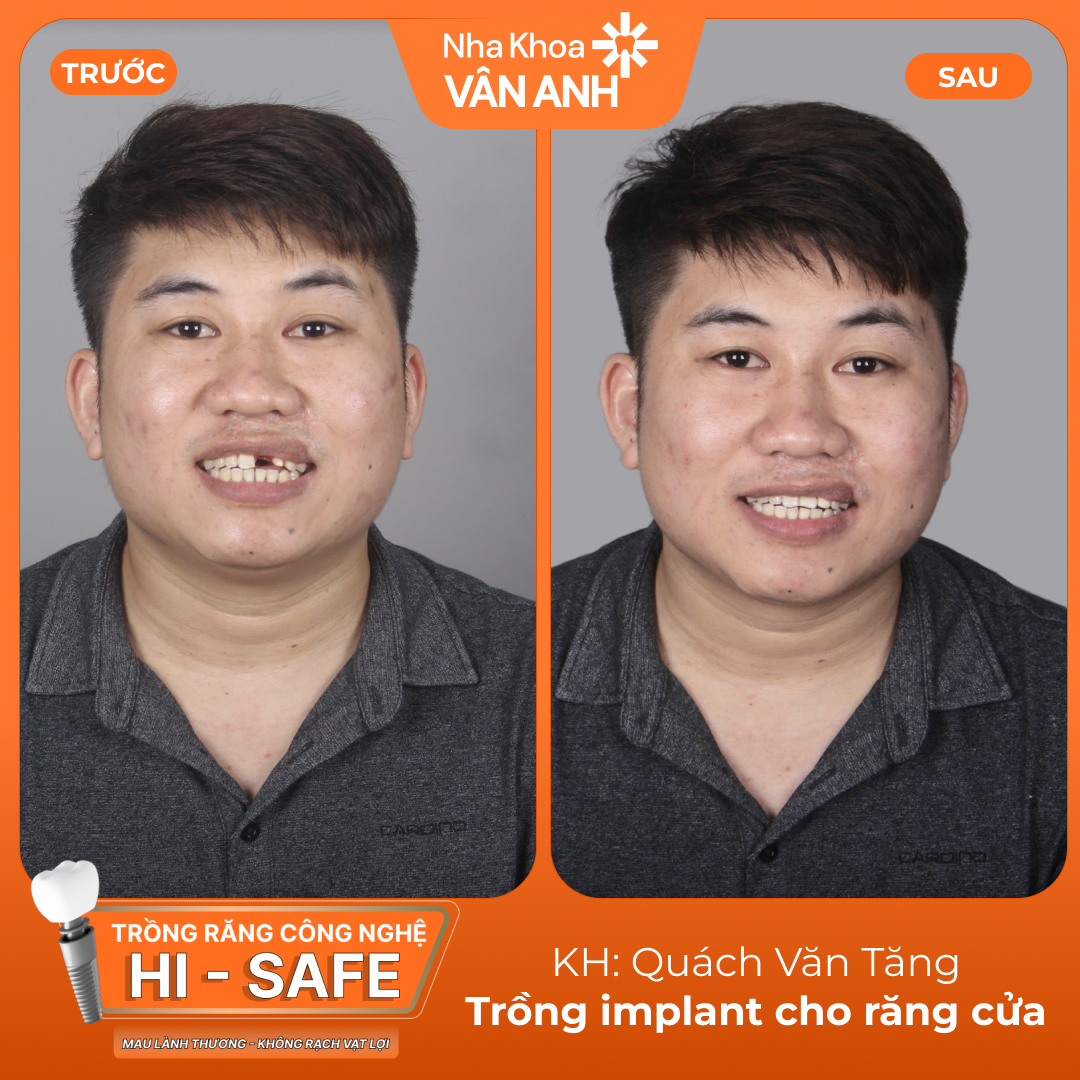 Trồng răng implant - Nha khoa Vân Anh